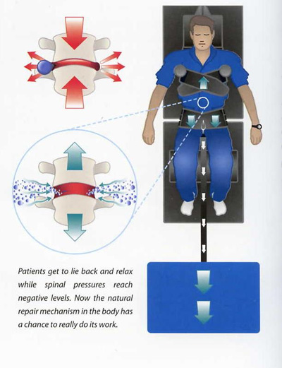 Spinal Decompression Therapy in Houston - Champions Chiropractic Center ...